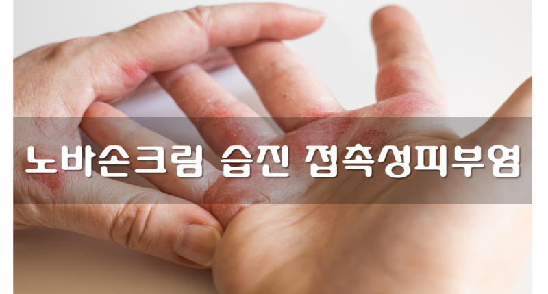 노바손 노바손크림 스테로이드 항생제 연고 알레르기성 피부질환 습진 접촉성피부염 건선 1도 화상 약국약 효능 효과 복용법 부작용