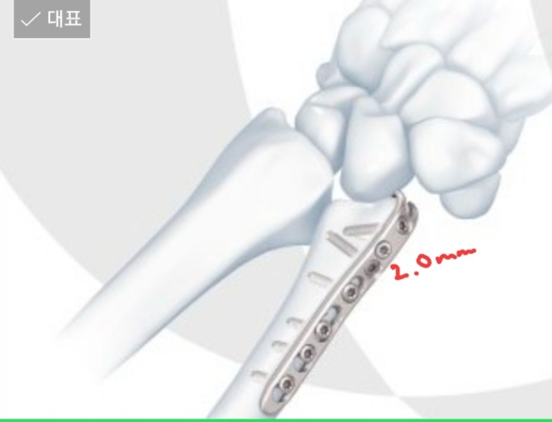 수술실 정형외과 스크럽- Wrist ORIF 보강 plate -hand ORIF : 네이버 블로그