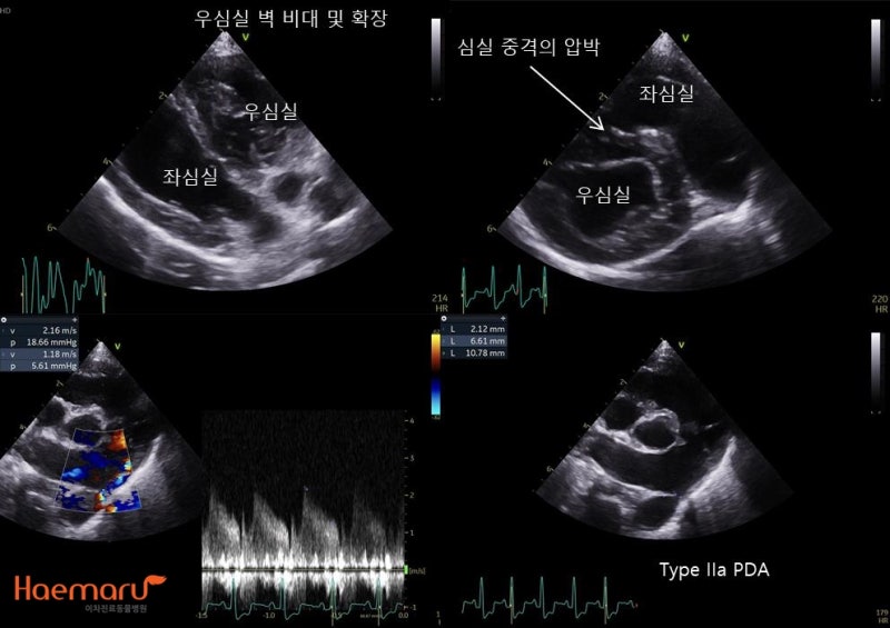 폐고혈압이 매우 심한 강아지의 PDA 비수술적 교정, ACDO 시술(bidirectional, R to L PDA) : 네이버 블로그