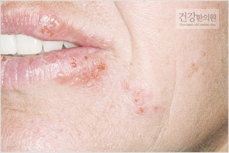 입술 헤르페스 전염 경로 입술 포진 치료방법은 네이버 블로그