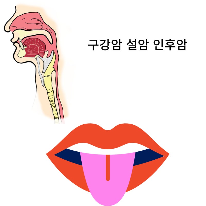 설암 초기증상 설암 구강암 인후암 원인 증상 위험인자 검사 치료시 부작용 네이버 블로그