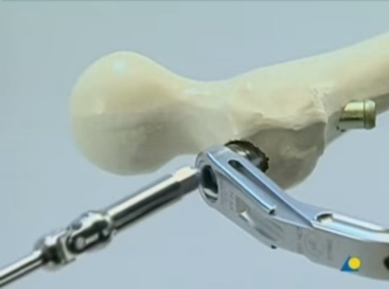수술실 정형외과스크럽 Femur fx(PFNA-3) blade insertion- PFNA procedure : 네이버 블로그