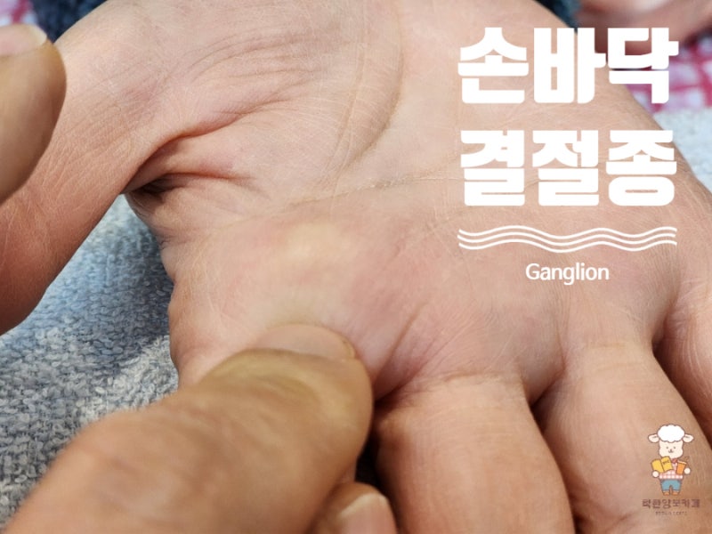 손바닥 결절종 원인과 검사 제거방법 총정리 손가락 물혹 그냥 나둬도 될까요 네이버 블로그