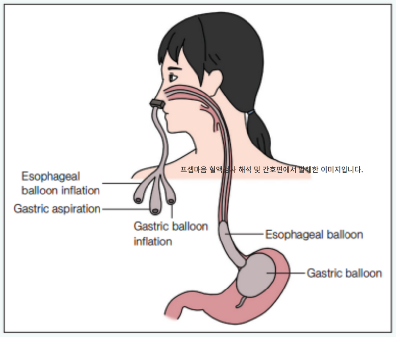 SB tube 정의, 치료 방법, 주의할 점 | 식도정맥류 파열 시 응급 시술 : 네이버 블로그