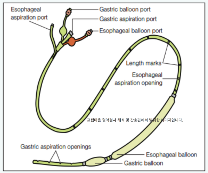SB tube 정의, 치료 방법, 주의할 점 | 식도정맥류 파열 시 응급 시술 : 네이버 블로그