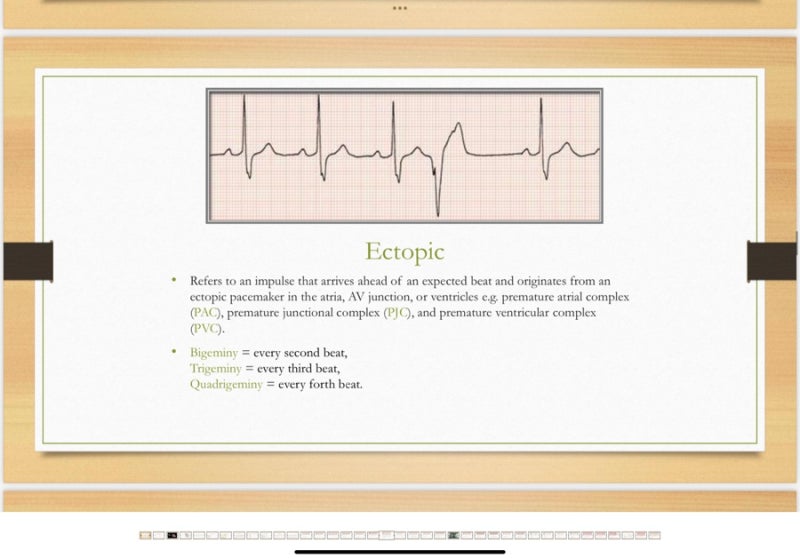 Ekg Pqrst 심방세동 심방조동 심실세동 심실빈맥 조기심실수축 차이 공부하기 네이버 블로그