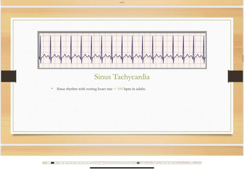 Ekg Pqrst 심방세동 심방조동 심실세동 심실빈맥 조기심실수축 차이 공부하기 네이버 블로그
