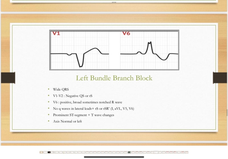 LBBB RBBB AV block 방실차단 공부하기 : 네이버 블로그