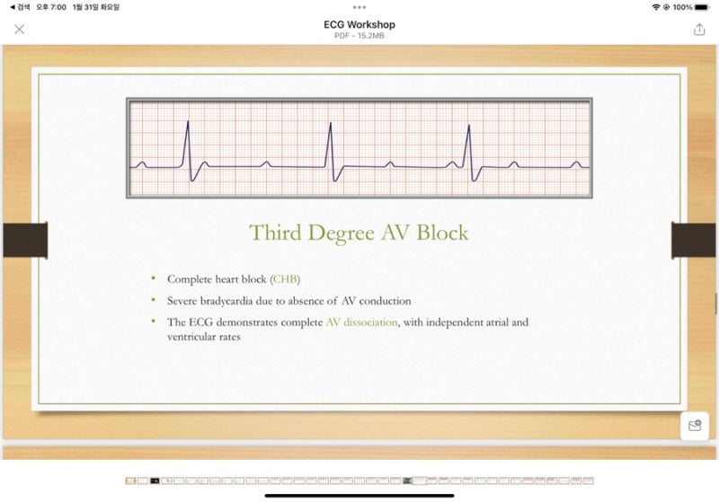 LBBB RBBB AV block 방실차단 공부하기 : 네이버 블로그