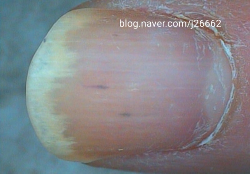 25. 손발톱밑선상출혈(가시출혈, Splinter hemorrhage) : 네이버 블로그