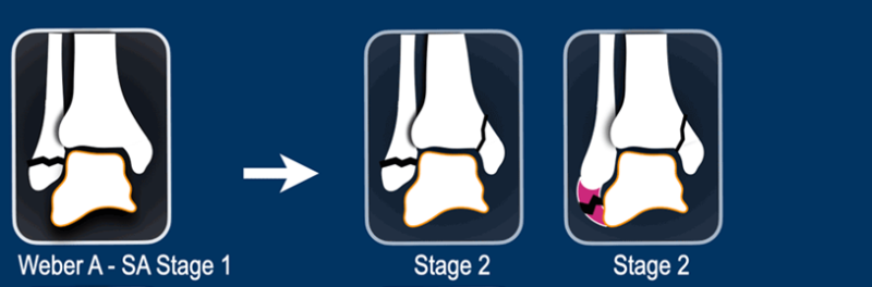 발목 골절, 진단 및 치료 알고리즘 (23년 1월 케이스 정리), ankle fracture classification and ...