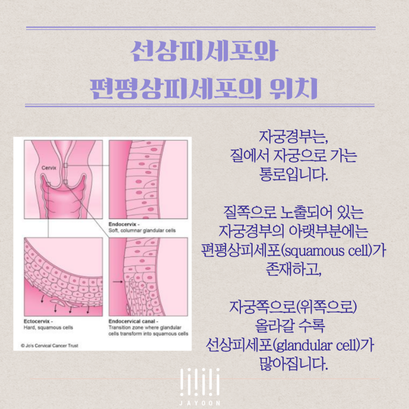 자궁경부암 비정형선상피세포agc 편평상피세포이상ascus Asc H보다 위험자궁내막암과 면역력자윤한의원 네이버 블로그