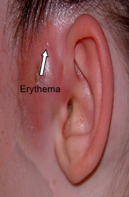 선천성 이루공(congenital preauricular sinus), 선천성 전이개누공(congenital ...