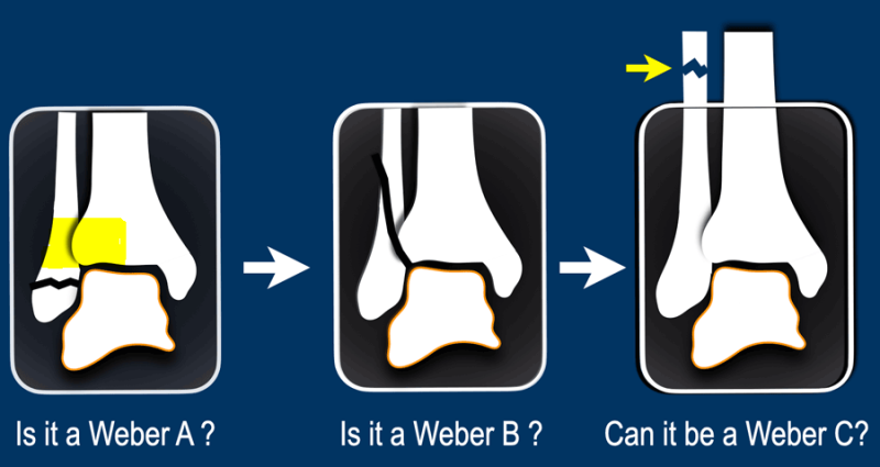 발목 골절, 진단 및 치료 알고리즘 (23년 1월 케이스 정리), ankle fracture classification and ...