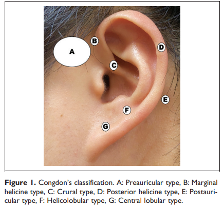 선천성 이루공(congenital preauricular sinus), 선천성 전이개누공(congenital ...
