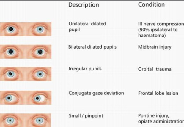 #뇌졸중(Stroke)3편_신경학적 검사 Neourological Exam (N/Ex) :GCS사정, pupil사정,소뇌 검사 ...