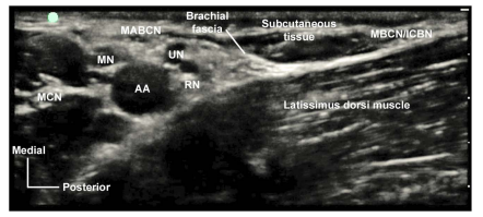 Intercostobrachial nerve block, medial brachial cutaneous nerve block에 ...