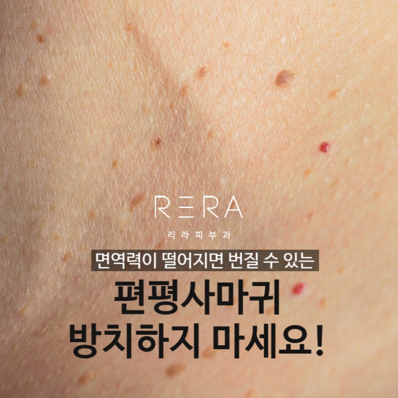 얼굴 목 편평사마귀 레이저 제거강남구청 피부과전문의번지기 전에 치료 네이버 블로그