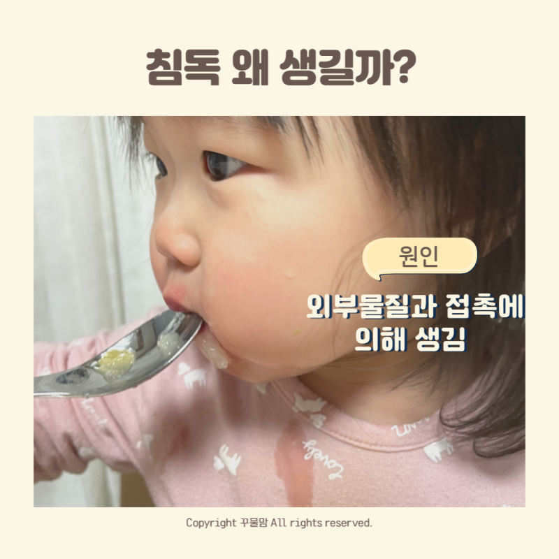 아기 접촉성 피부염 아기 침독 비판텐 아쿠아퍼 연고 치료법 네이버 블로그