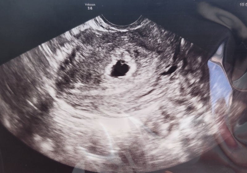 아기집 보이는 시기 언제일까 난황까지 한번에본 후기 네이버 블로그