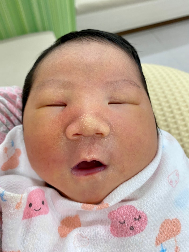 신생아 비립종 원인 치료 및 없어지는 시기 관리방법 네이버 블로그