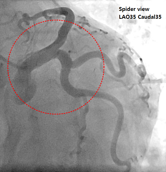 심혈관(관상동맥)조영술의 일반적인 순서와 이론, 조영술의 실제관심영역 : 네이버 블로그