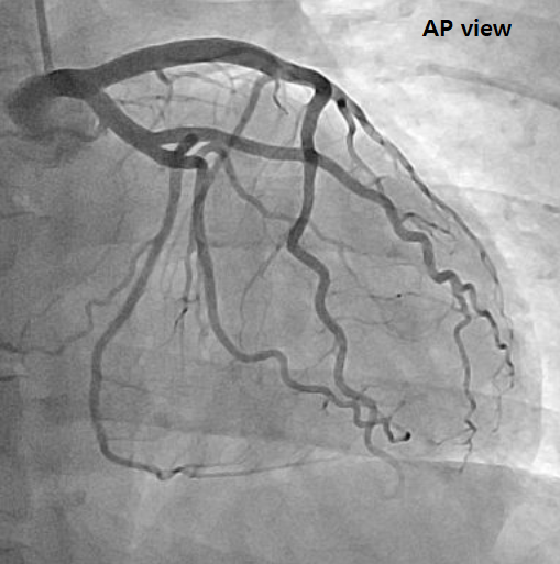 심혈관(관상동맥)조영술의 일반적인 순서와 이론, 조영술의 실제관심영역 : 네이버 블로그