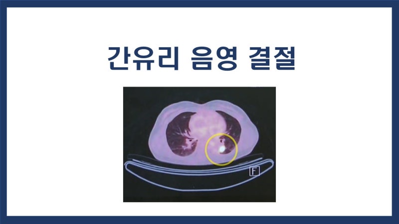 폐암 검사 결과 간유리 음영 결절 고립성 폐결절 양성 추정 결절 폐결절 외 소견 네이버 블로그