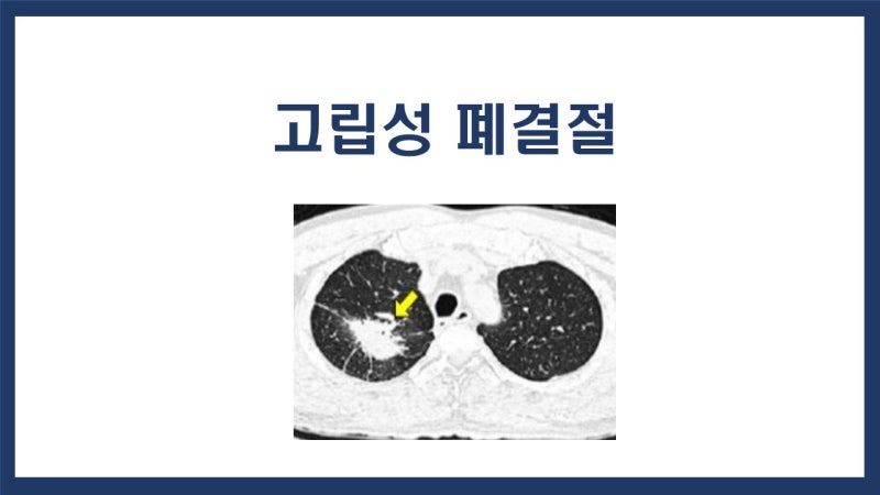 폐암 검사 결과 간유리 음영 결절 고립성 폐결절 양성 추정 결절 폐결절 외 소견 네이버 블로그