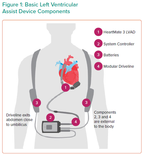 Heartmate 3 - LVAD, Left ventricular assist device 좌심실보조장치 : 네이버 블로그