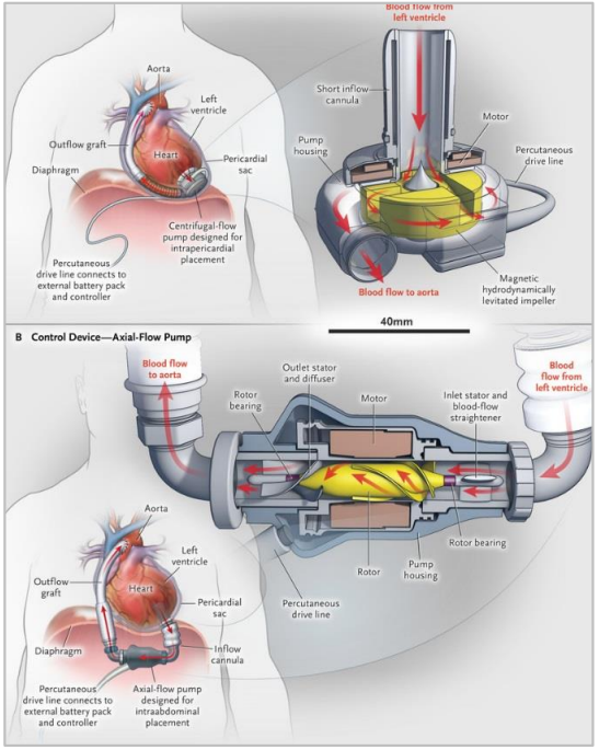 Heartmate 3 - LVAD, Left ventricular assist device 좌심실보조장치 : 네이버 블로그