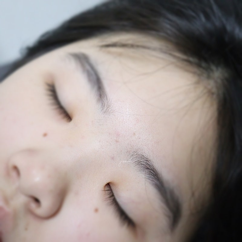 얼굴 뾰루지 여드름 흉터 없애는 법 낫츠 센텔라스카 연고로 다스려요 네이버 블로그