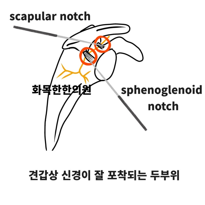 대전어깨관절통증 어깨관절통 견관절통 견갑상신경 극하근 극상근 네이버 블로그