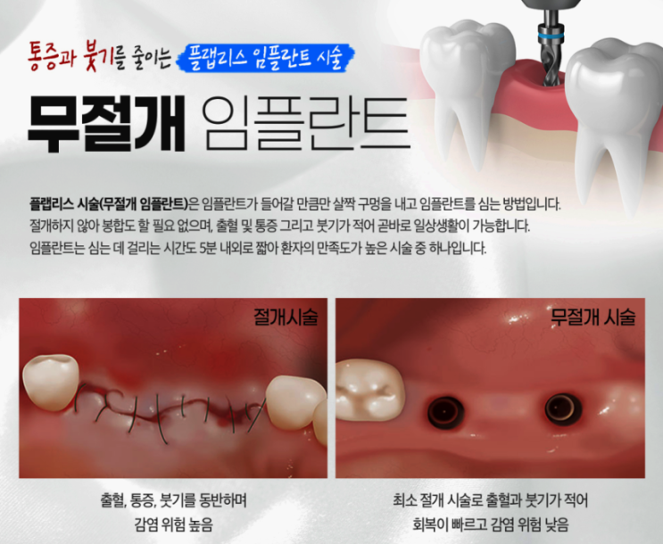 방이동 둔촌동 성내동 치과 오래된 브릿지 제거 후 임플란트로 교체