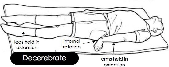 Decerebrate? Decorticate? (feat. 제뇌자세, 제피질자세) : 네이버 블로그