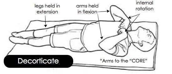 Decerebrate? Decorticate? (feat. 제뇌자세, 제피질자세) : 네이버 블로그