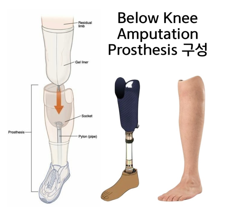 절단환자 재활(Amputation Rehab_Below Knee) : 네이버 블로그