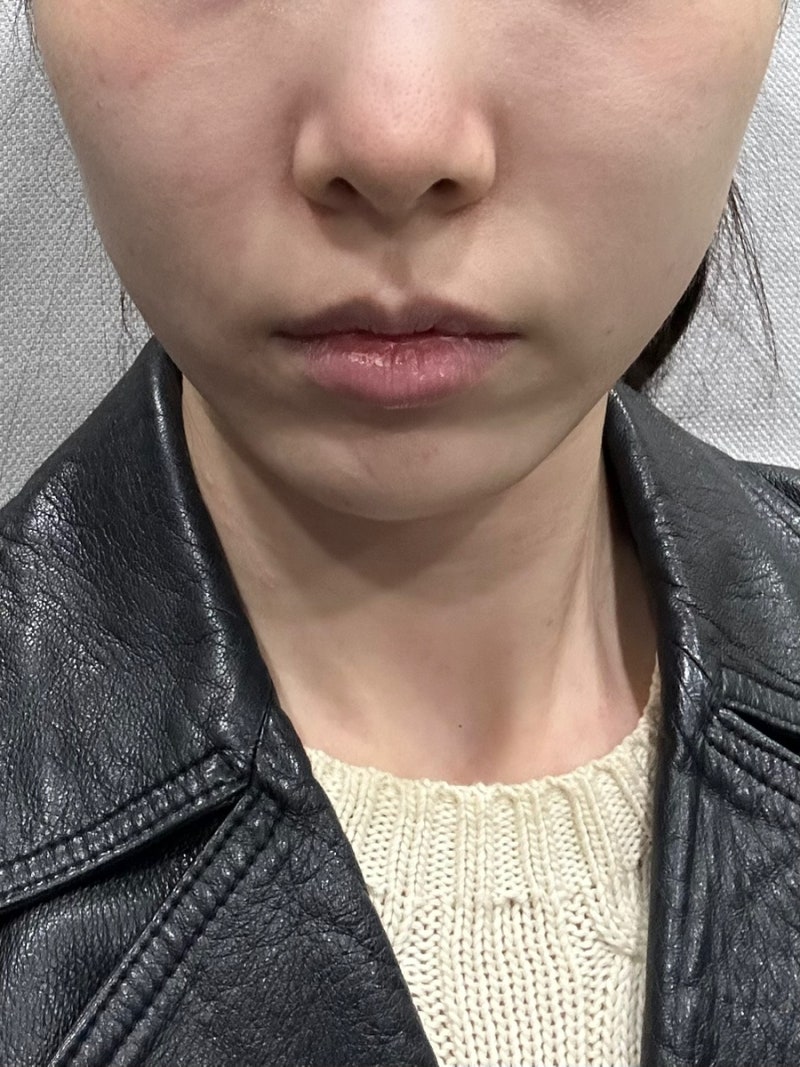쥬베룩 볼륨 삼성 피부과 솔직 후기 전후붓기부작용효과 등 네이버 블로그