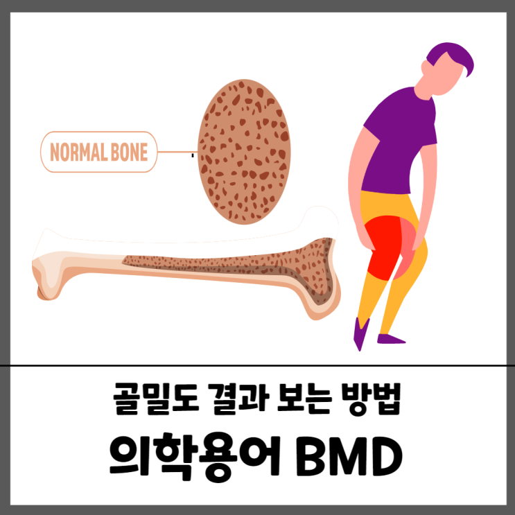 의학용어 Bmd 골밀도검사 결과 수치 비용 알아보기