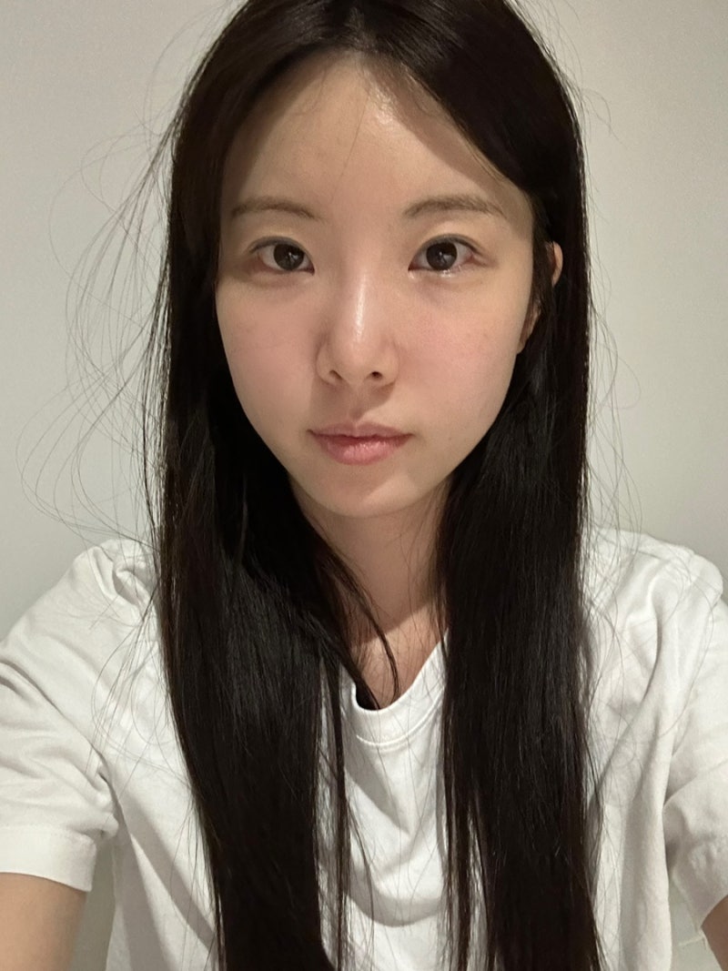 쥬베룩 볼륨 삼성 피부과 솔직 후기 전후붓기부작용효과 등 네이버 블로그