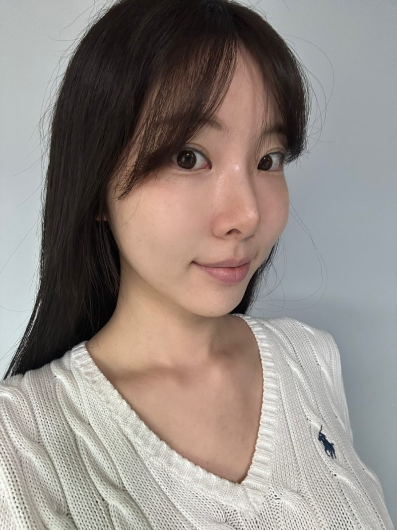쥬베룩 볼륨 삼성 피부과 솔직 후기 전후붓기부작용효과 등 네이버 블로그