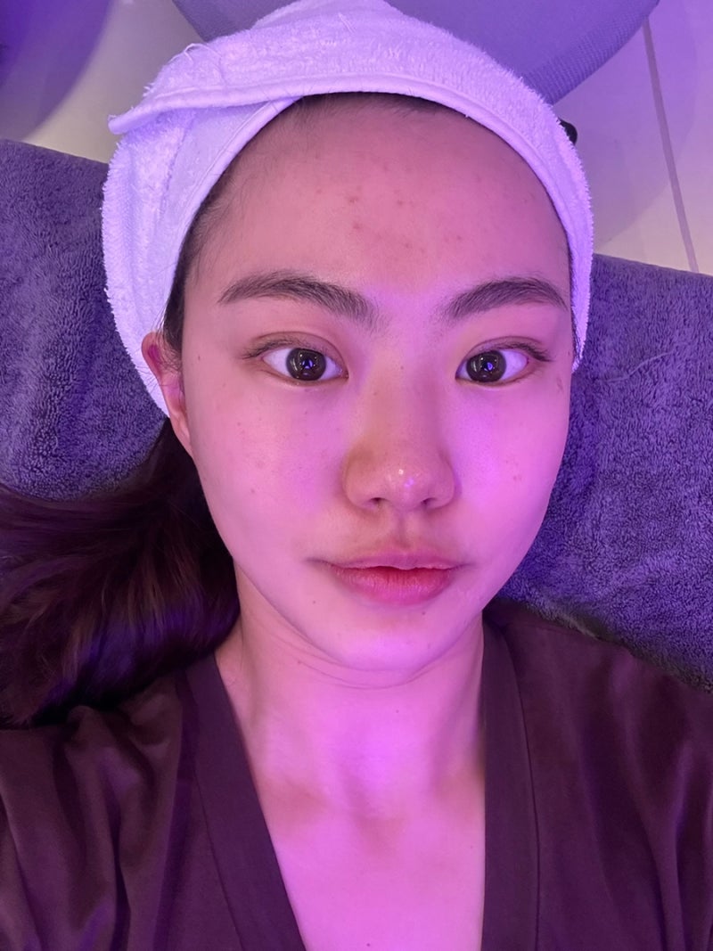 청담 피부과 티타늄리프팅 후기 효과가 바로 보이는 저통증 리프팅시술 티타늄리프팅 가격 고통 유지기간 3주 후
