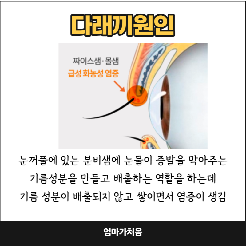 다래끼 빨리 낫는 법 초기증상 약 예방법까지 모두 정리 네이버 블로그