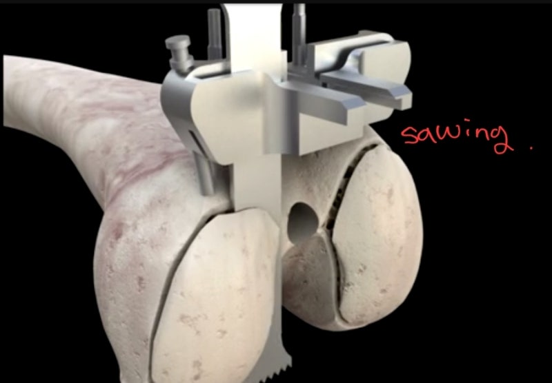 수술실스크럽-TKR procedure 1 -Total PS(Posterior Stabilied) Knee Replacement ...