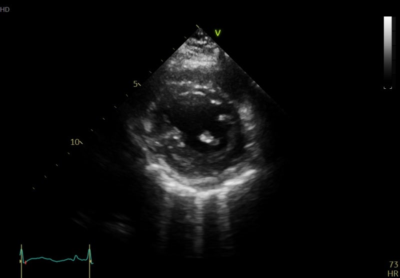 Constrictive pericarditis(교착성 심내막염) : 네이버 블로그