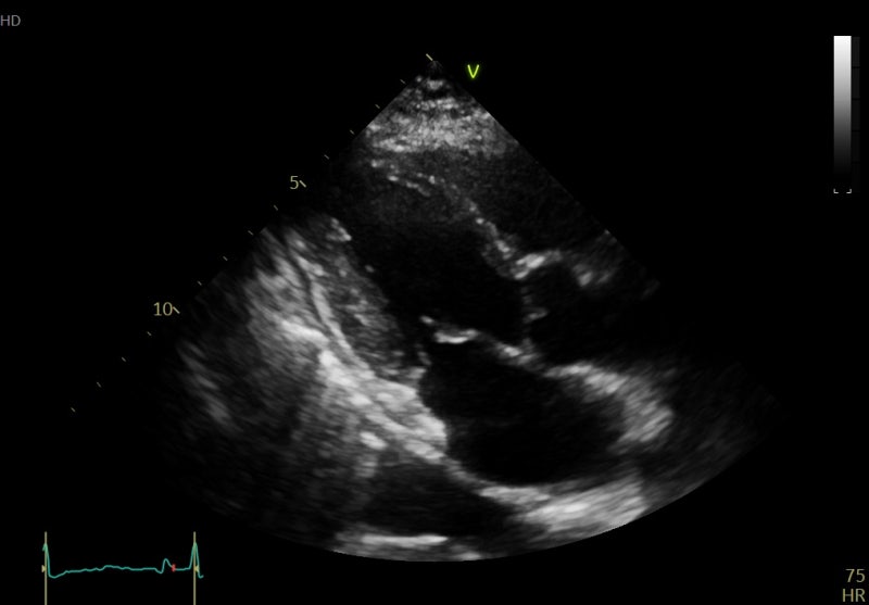 Constrictive pericarditis(교착성 심내막염) : 네이버 블로그