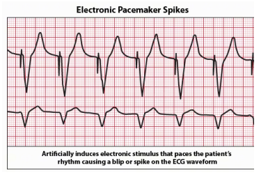 Temporary Pacemaker(TPM), 임시심박동기 : 네이버 블로그