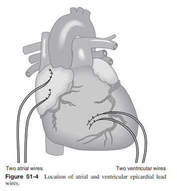 Temporary Pacemaker(TPM), 임시심박동기 : 네이버 블로그