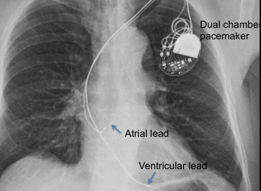 Temporary Pacemaker(TPM), 임시심박동기 : 네이버 블로그