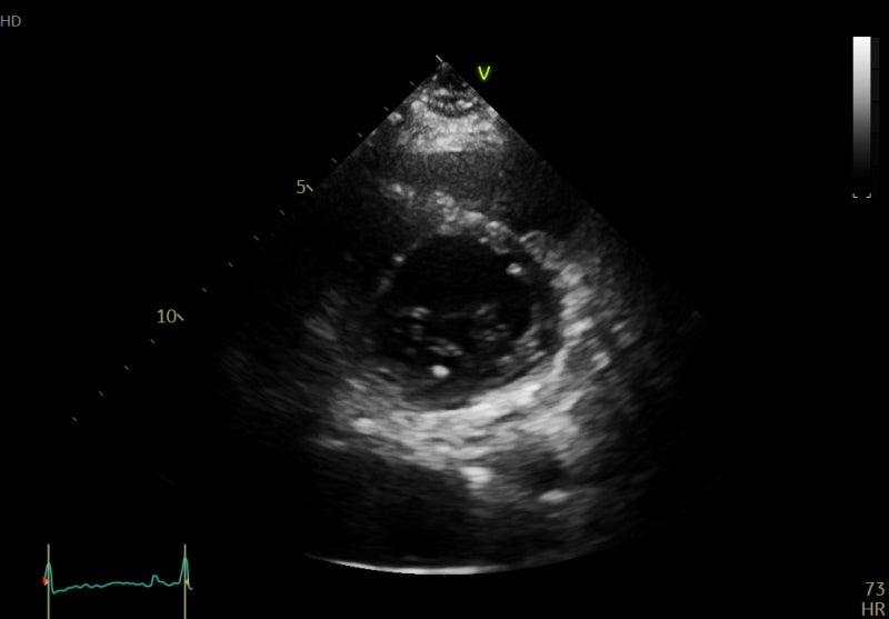 Constrictive pericarditis(교착성 심내막염) : 네이버 블로그